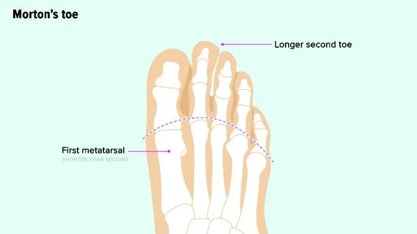 The "Greek toe" of the Caryatids: Can your feet reveal your Greek ancestry?