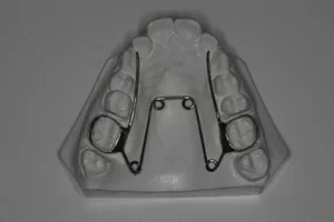 Expansion Appliances — DR CHARLES SHERIDAN | ORTHODONTICS