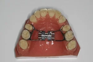 Expansion Appliances — DR CHARLES SHERIDAN | ORTHODONTICS