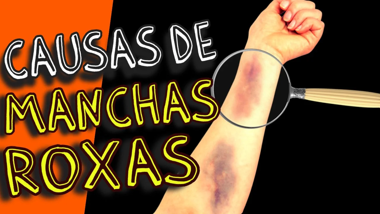 MANCHAS ROXAS NO CORPO: Quais as causas? Devo me PREOCUPAR?- equimose e ...