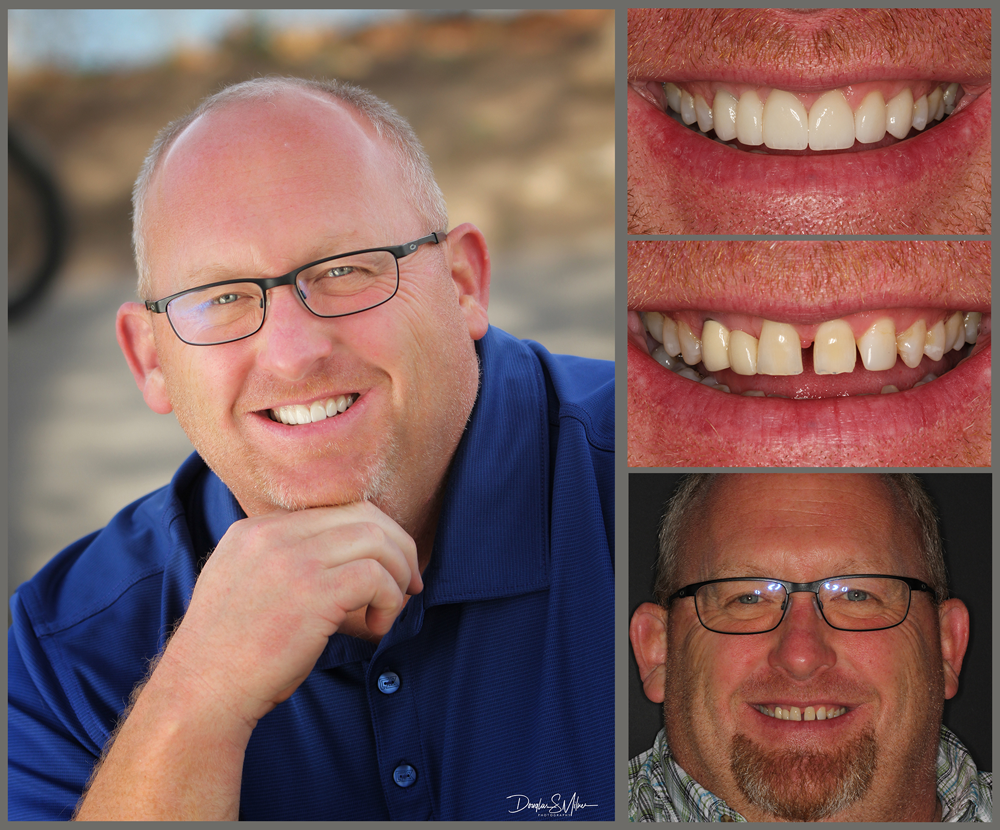 Smile Gallery — Fibonacci Smile | Wenatchee Dentist