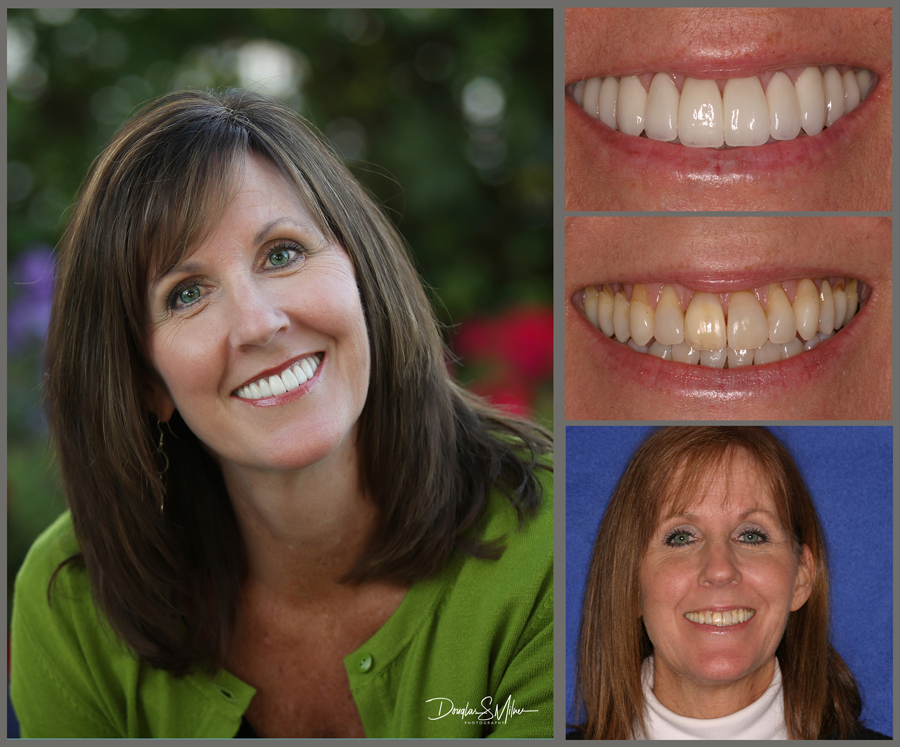 Smile Gallery — Fibonacci Smile | Wenatchee Dentist