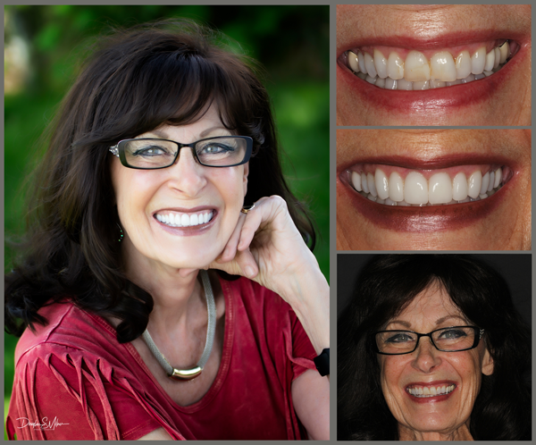 Smile Gallery — Fibonacci Smile | Wenatchee Dentist