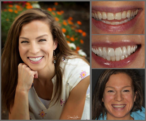 Smile Gallery — Fibonacci Smile | Wenatchee Dentist