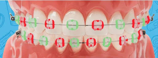 Braces Colors for Summer | Rector Orthodontics Blog — Rector Orthodontics