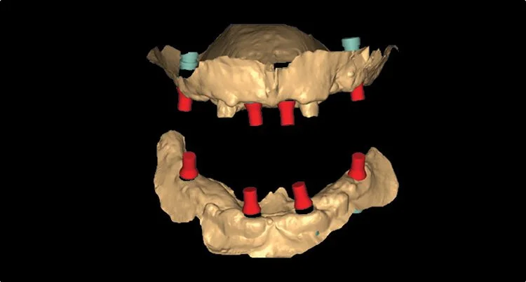 Full-Arch Photogrammetry — MicroDental Laboratories
