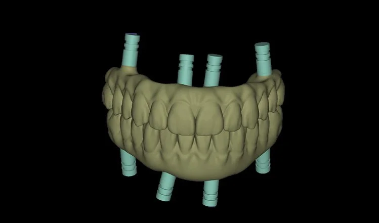 Full-Arch Photogrammetry — MicroDental Laboratories