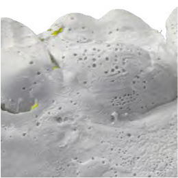 Stone Cast Discrepancies — MicroDental Laboratories