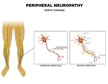 Neuropathy — Foot and Ankle Specialists