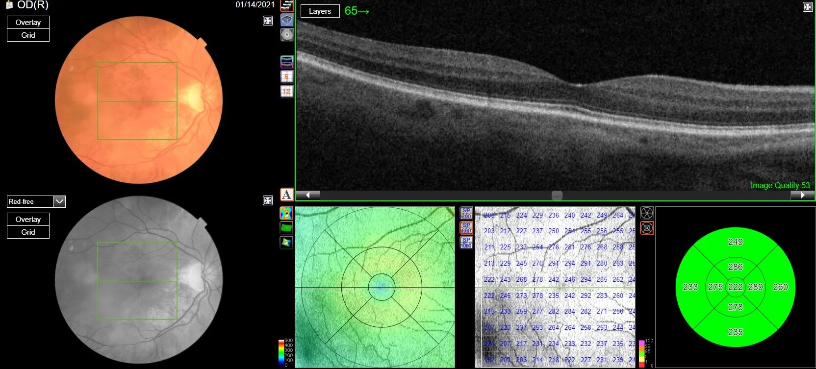 Eye Disease Treatment — MILE HIGH EYECARE