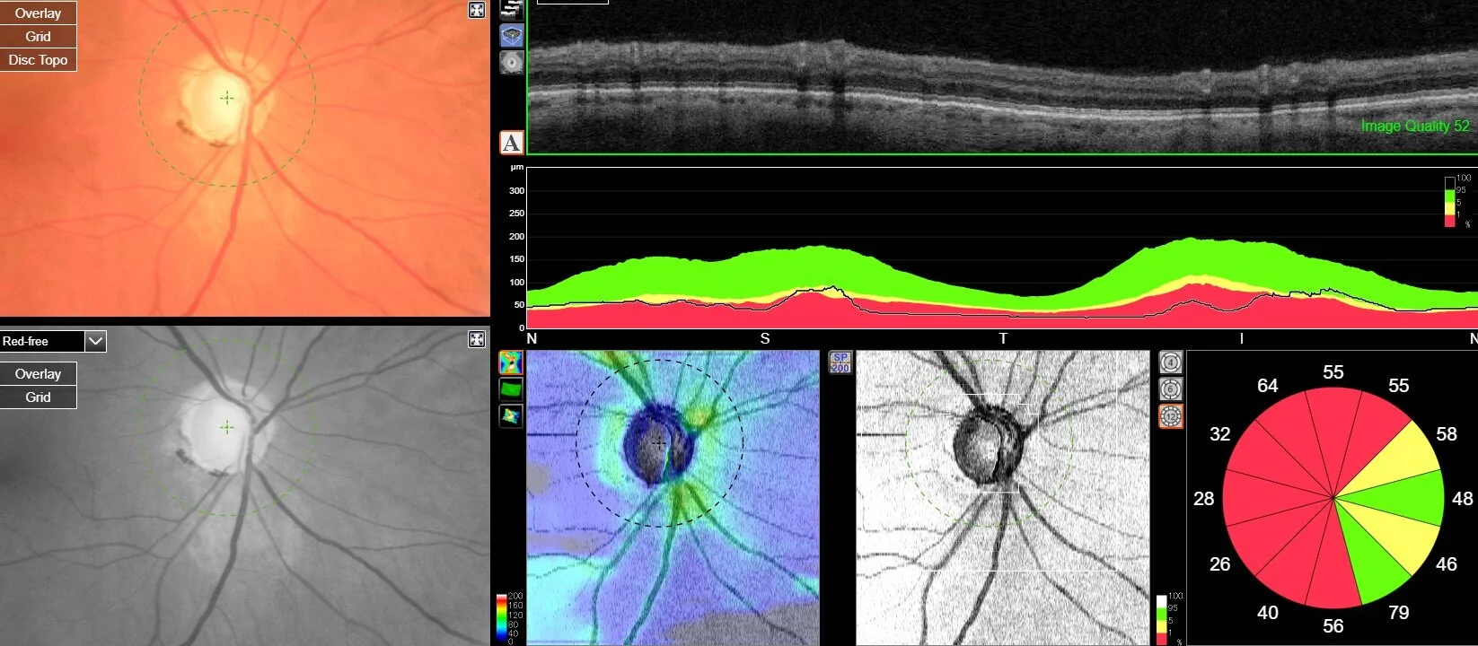 Eye Disease Treatment — MILE HIGH EYECARE