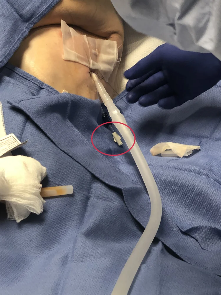 All About Chest Tubes — Pulmcast | ICU APP Fellowship | Critical Care ...