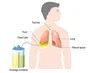 All About Chest Tubes — Pulmcast | ICU APP Fellowship | Critical Care ...