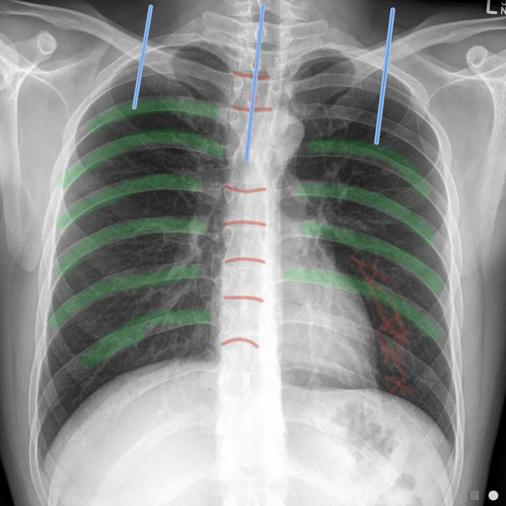 Reading Imaging — Pulmcast | ICU APP Fellowship | Critical Care Training