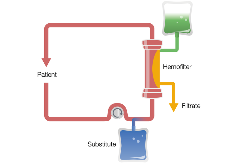 CRRT (Continuous renal replacement therapy) — Pulmcast | ICU APP ...