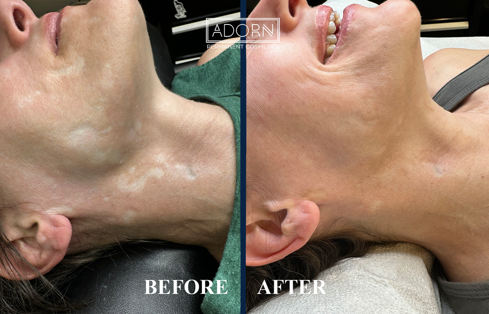 Scar Camouflage with Permanent Makeup — Adorn Permanent Cosmetics ...