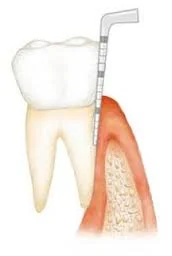 Periodontal Probe Measurements