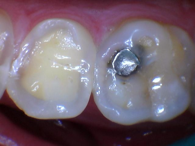 Why is acid bad for your teeth?