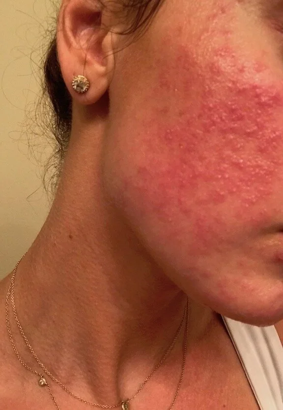 Rosacea On Neck