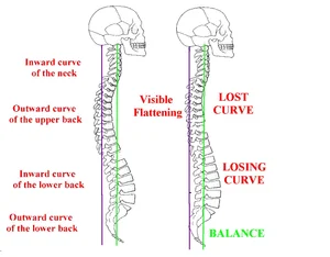 Losing the Spring: Flat Thoracic Spines — Black Bear Physical Therapy