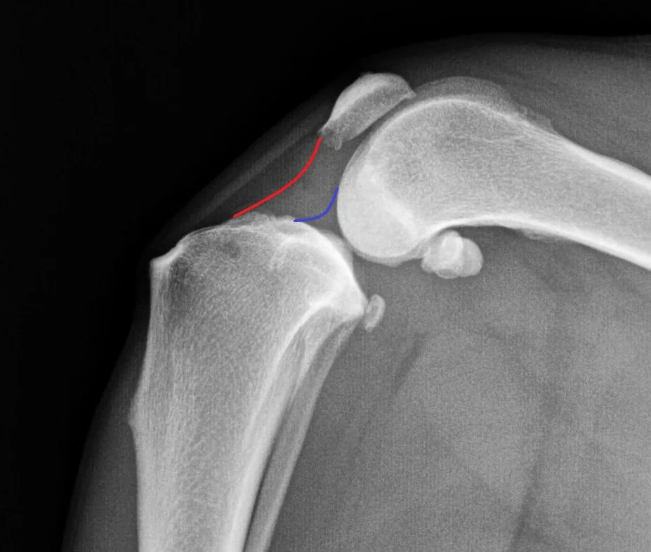 TPLO — Warm Springs Pet Hospital
