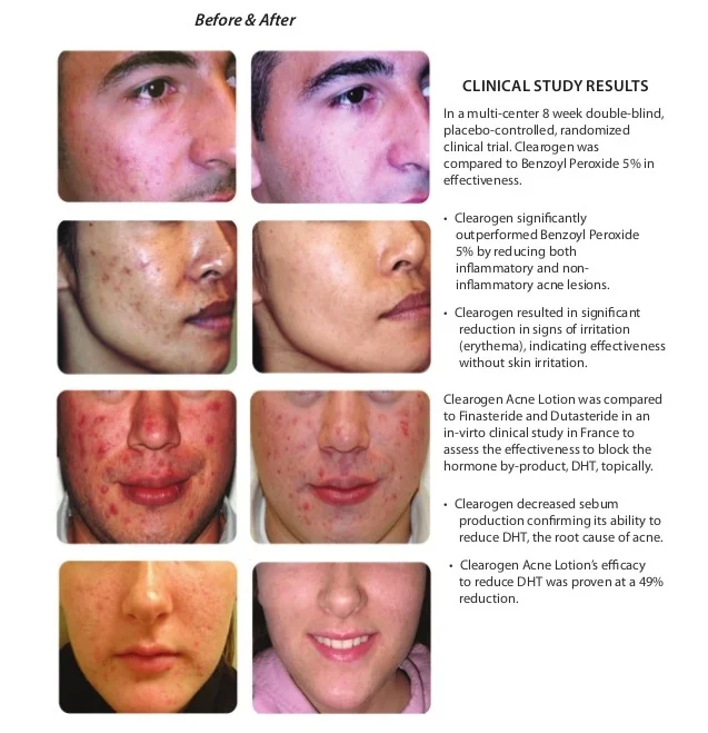 Learn More About Clearogen's 3 Step Acne System — DermaEnvy Skincare ...