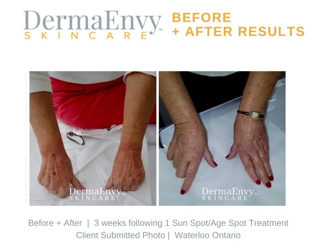 IPL Photo Rejuvenation | PhotoFacial near me | Skin Rejuevenation ...