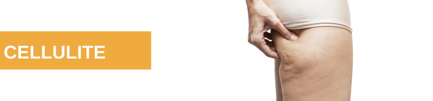 Cellulite — DermaEnvy Skincare | Medical Aesthetics , Laser Hair ...