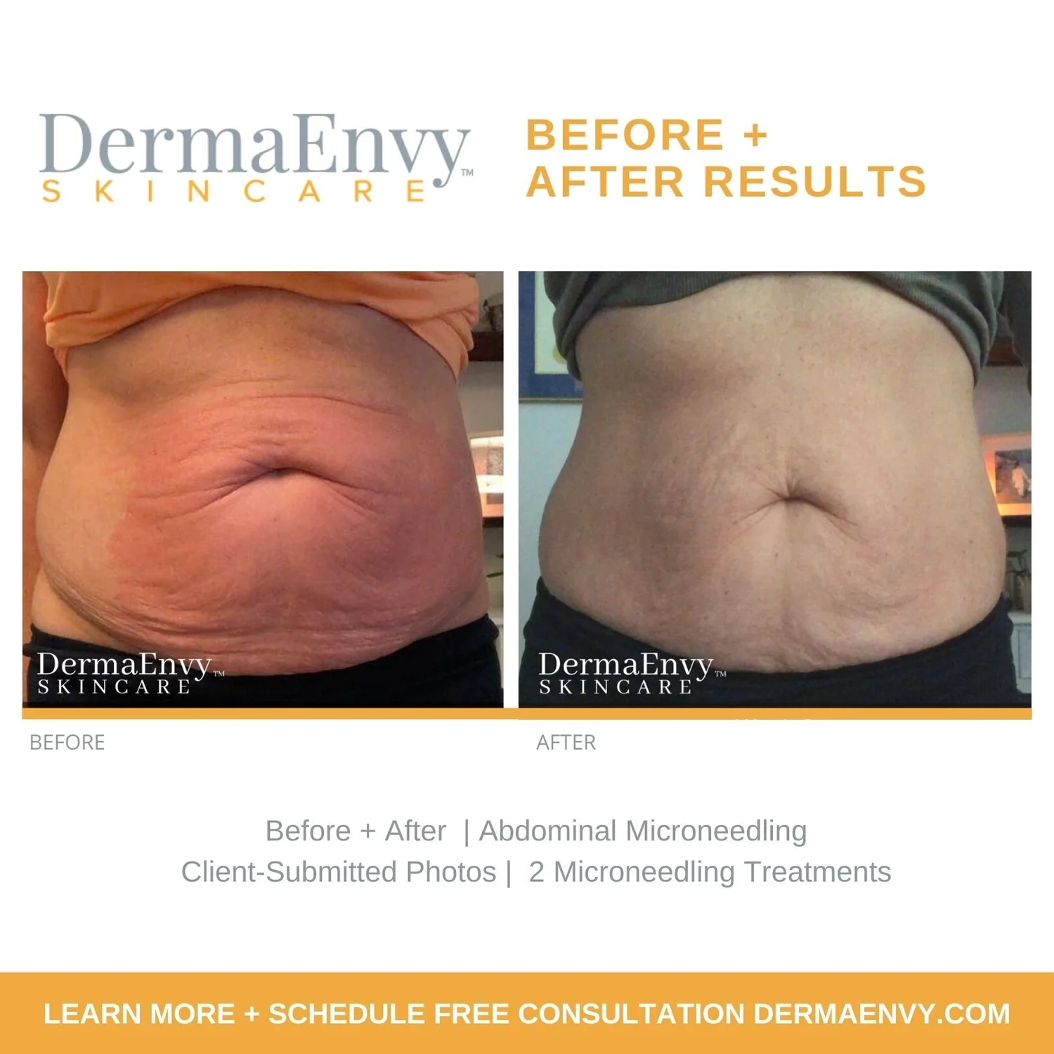 Microneedling near me | Skin Needling Facial | Dermapen Treatments ...