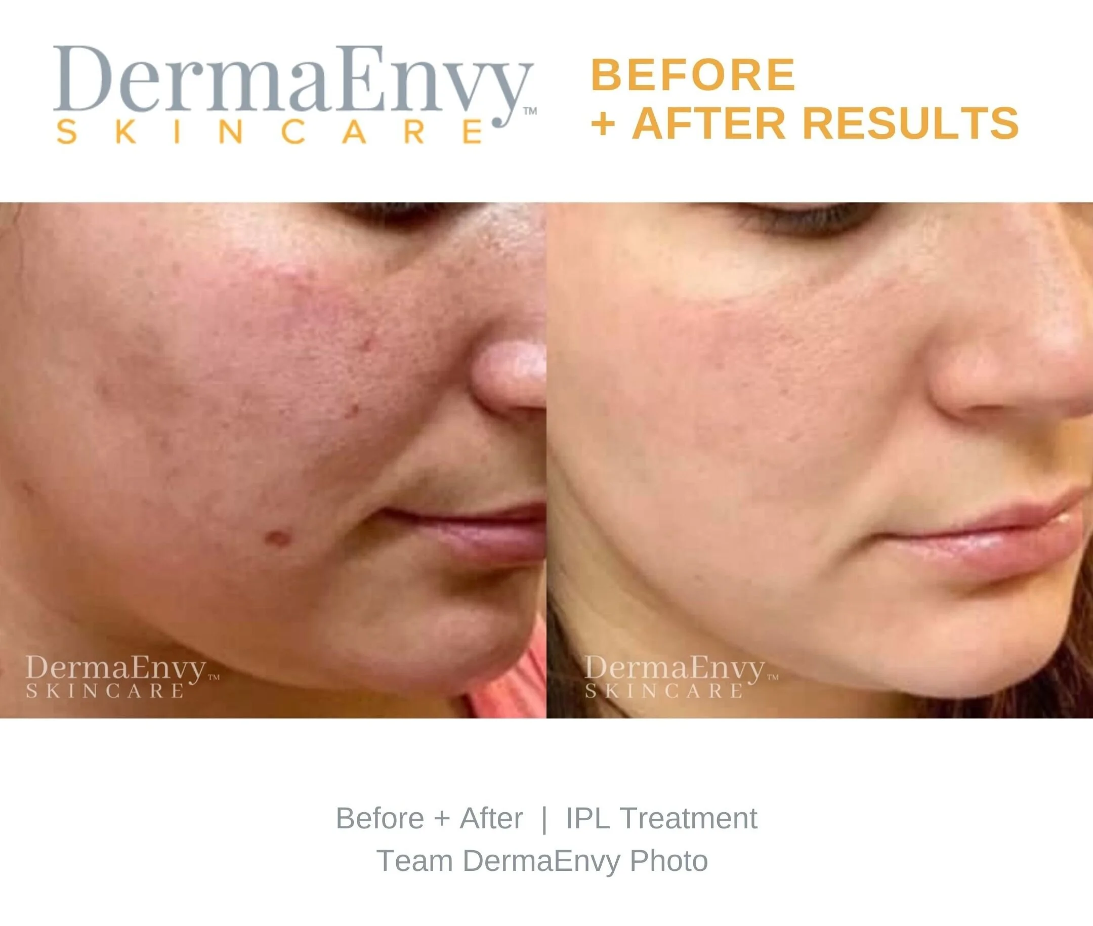 IPL Photo Rejuvenation | PhotoFacial near me | Skin Rejuevenation ...