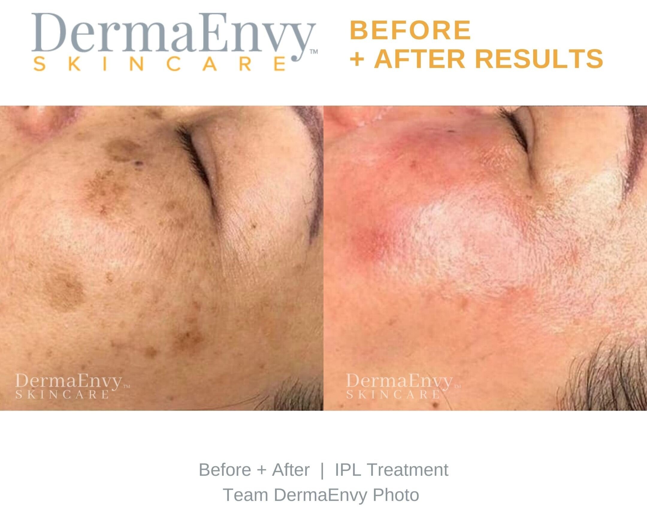 IPL Photo Rejuvenation | PhotoFacial near me | Skin Rejuevenation ...