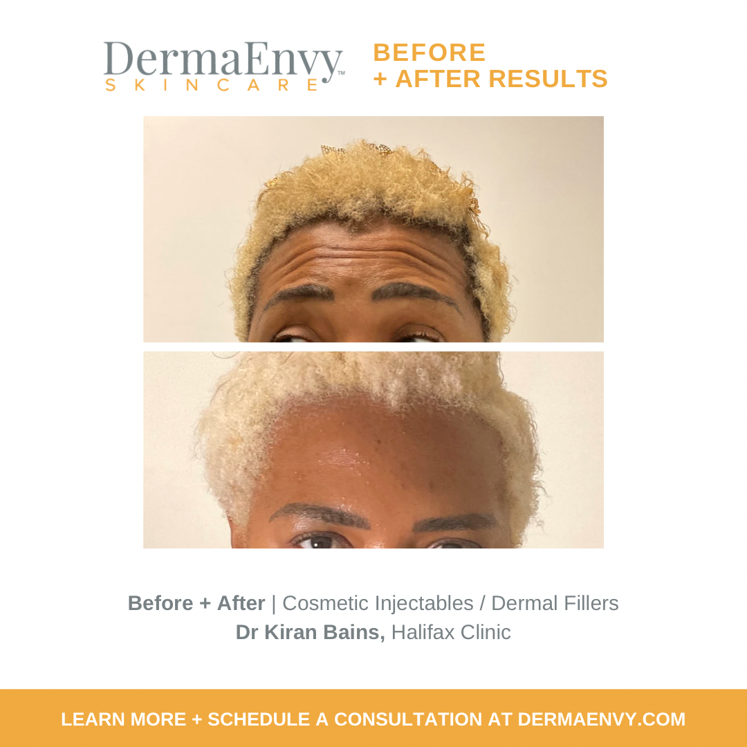 Wrinkle Treatments | Cosmetic Aesthetic Injections | Botox Halifax ...