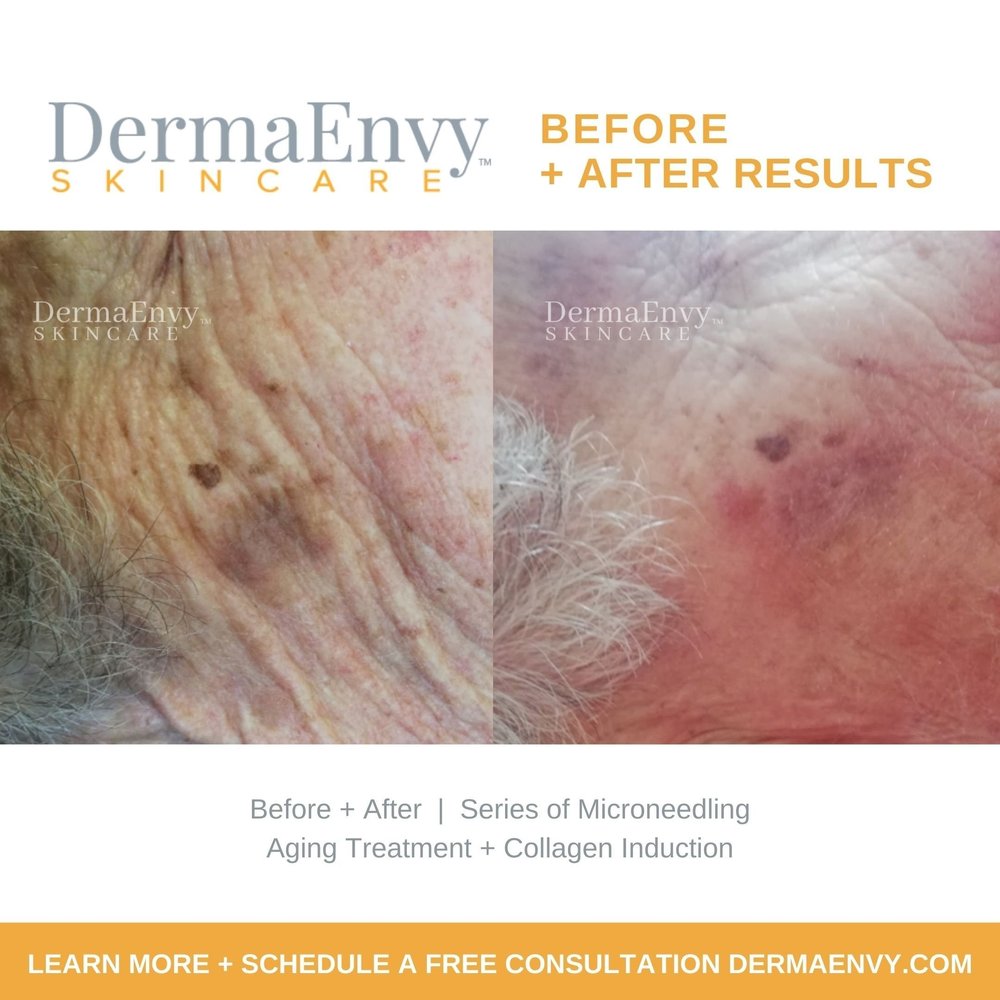 Microneedling near me | Skin Needling Facial | Dermapen Treatments ...