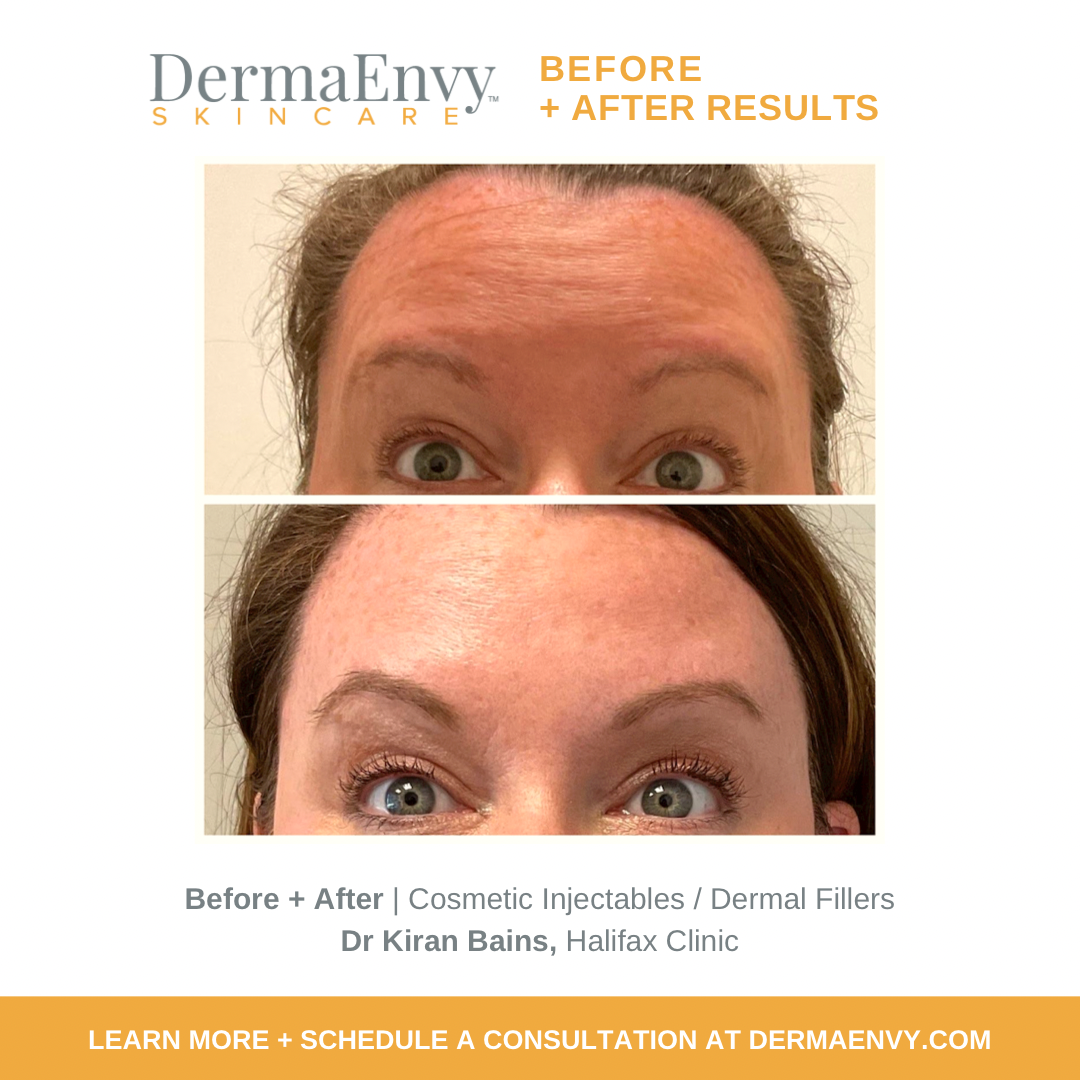 Wrinkle Treatments | Cosmetic Aesthetic Injections | Botox Halifax ...