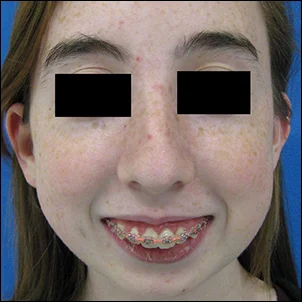 Maxillary Prognathism Correction