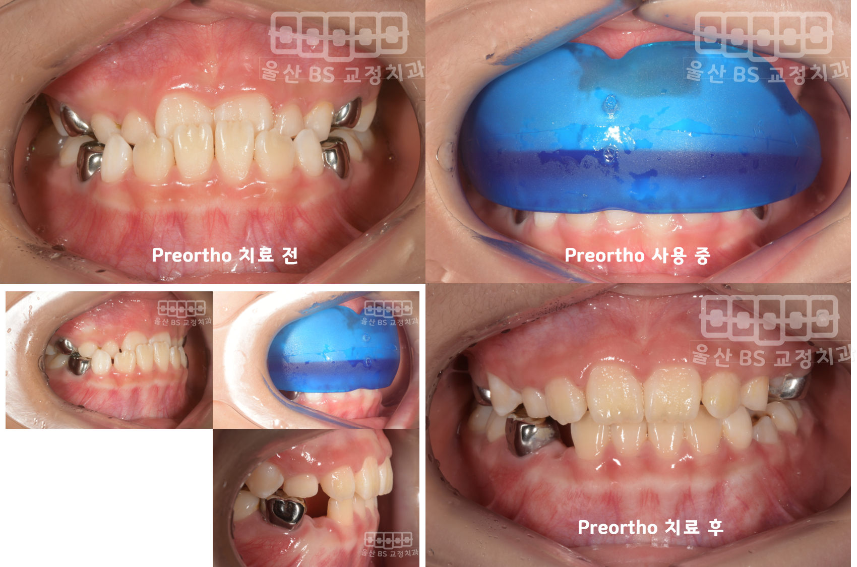 PreOrtho — 울산BS교정치과