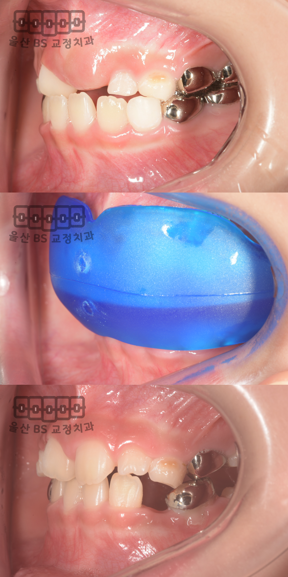 preortho를 이용한 반대교합의 치료 — 울산BS교정치과