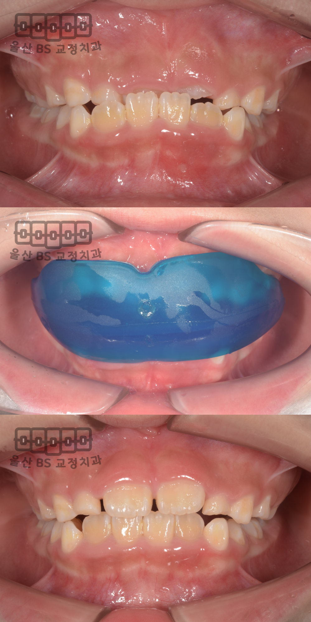 preortho를 이용한 반대교합의 치료 — 울산BS교정치과
