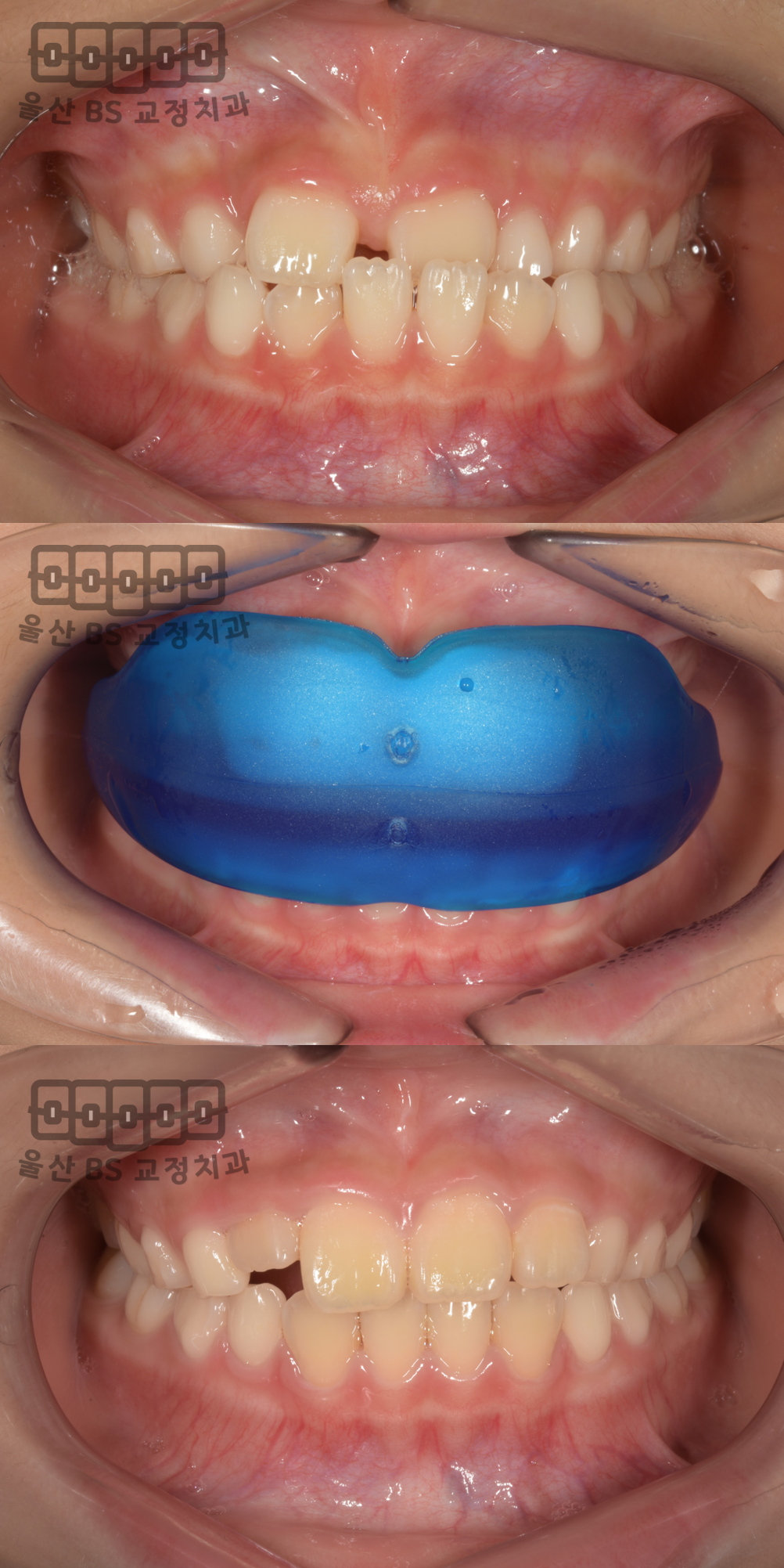 preortho를 이용한 반대교합의 치료 — 울산BS교정치과