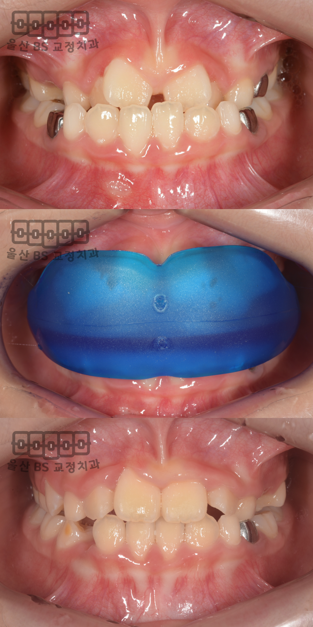 preortho를 이용한 반대교합의 치료 — 울산BS교정치과