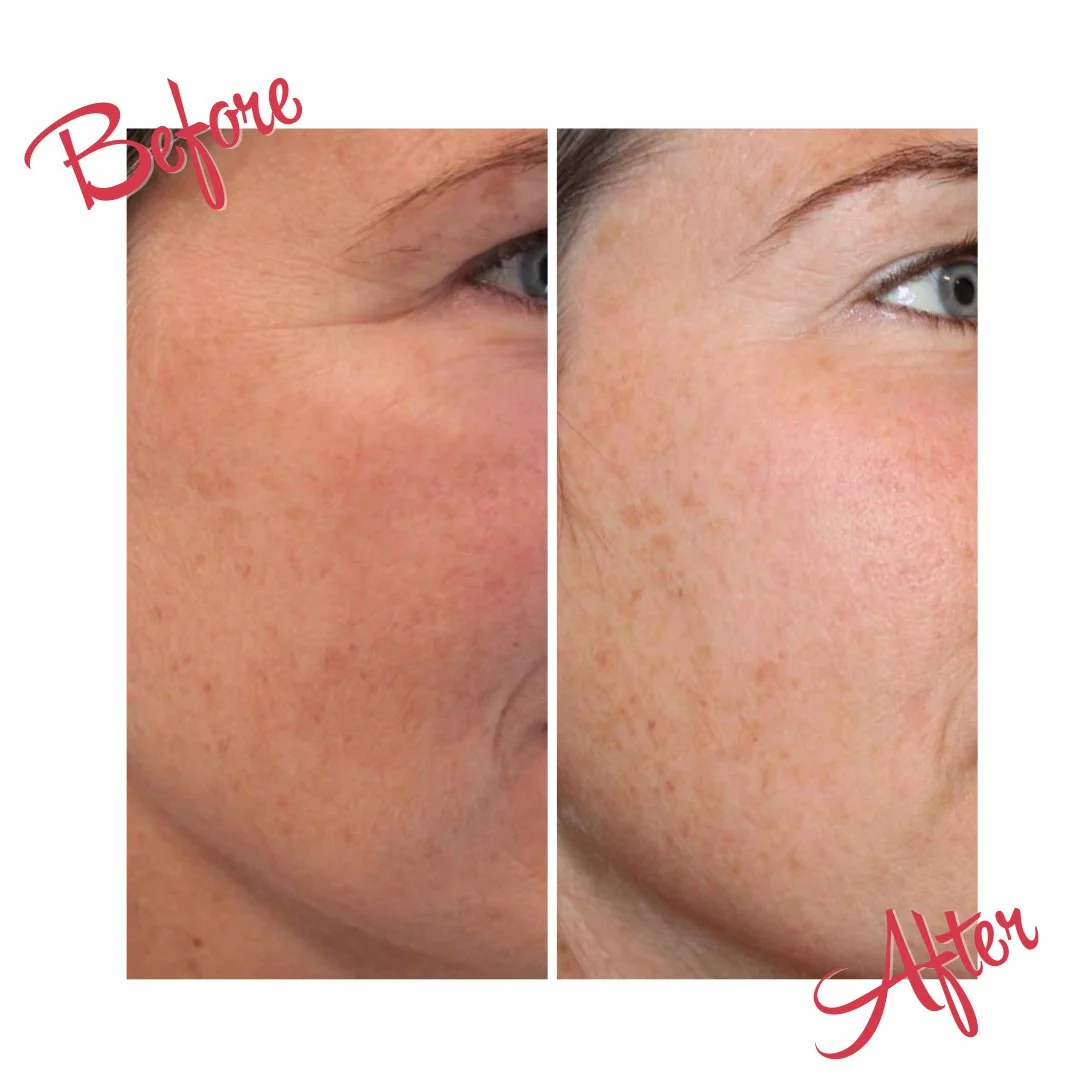 LED Light Therapy — Therapeutic Bodywork