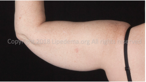 Staging of Lipedema — Lipedema Foundation