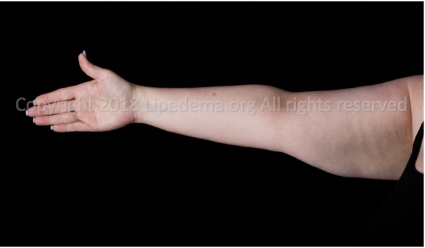 Staging of Lipedema — Lipedema Foundation