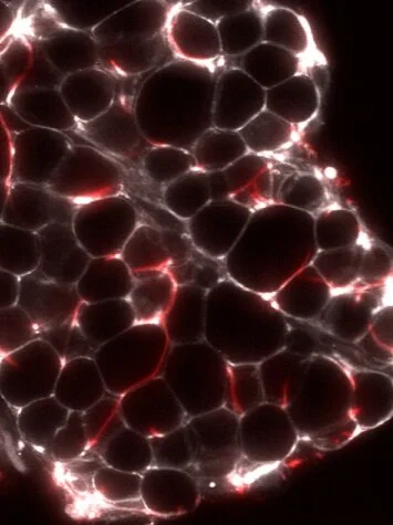 Understanding lipedema onset and progression — Lipedema Foundation