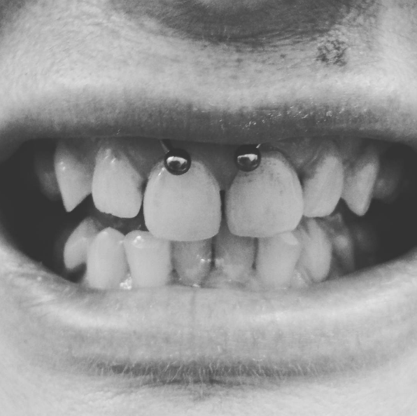 Smiley Piercing Teeth Damage