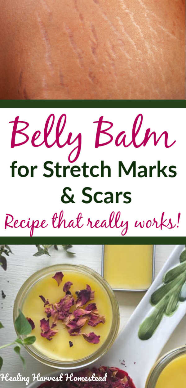 How to Get Rid of Stretch Marks Fast and Naturally at Home — All Posts ...