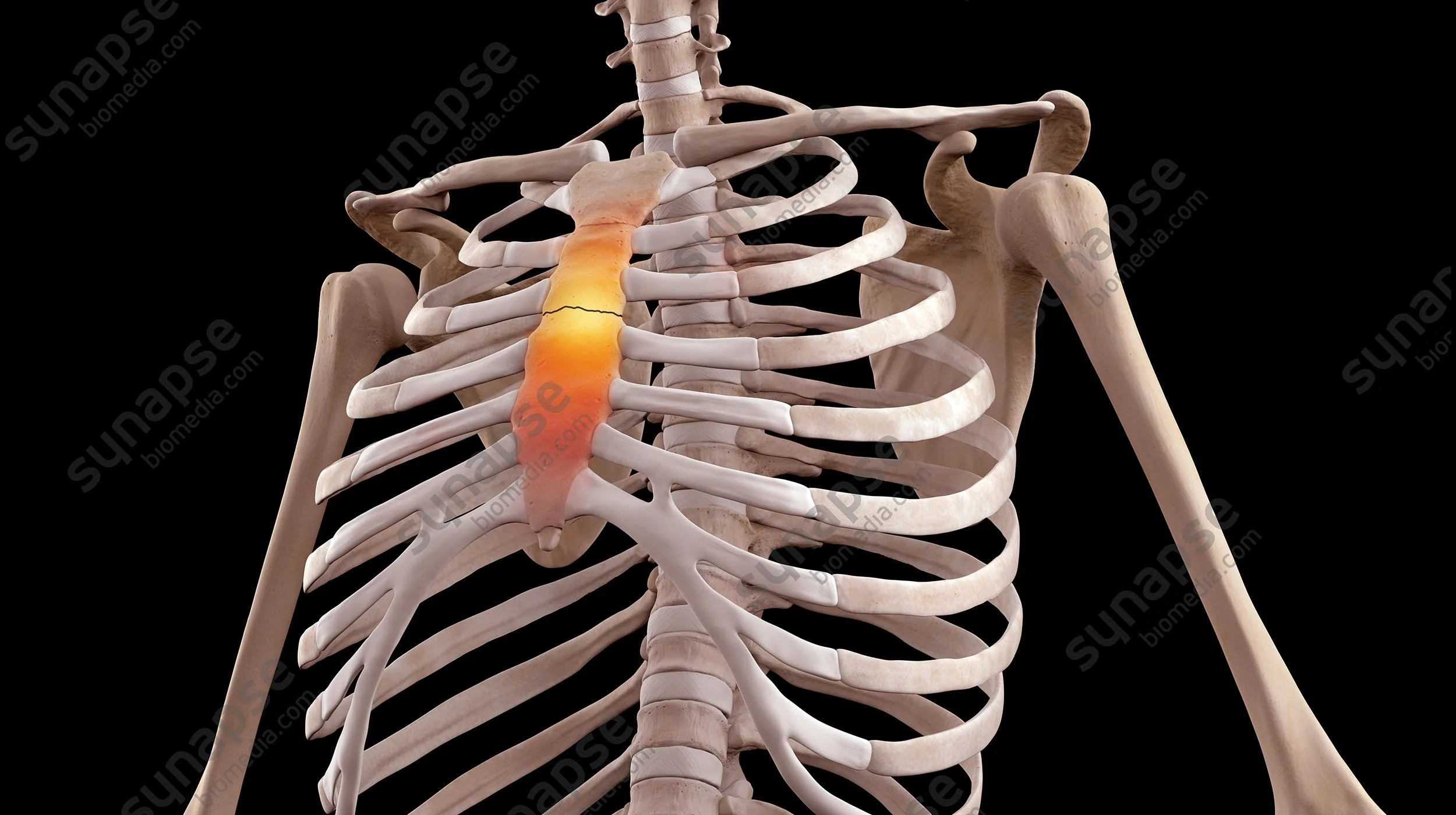Sternum fracture skeleton torso — Synapse Biomedia