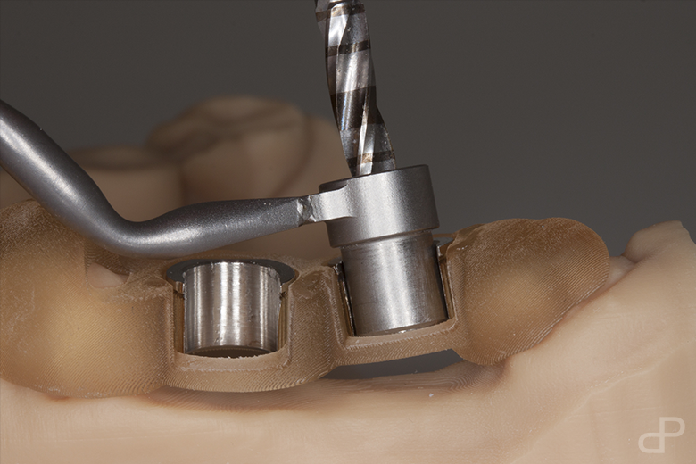 Paul Ro Dental Lab, Dental Lab, Implant, Digital Dentistry, Surgical Guide