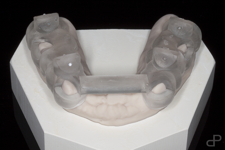 Paul Ro Dental Lab, Dental Lab, Implant, Digital Dentistry, Surgical Guide