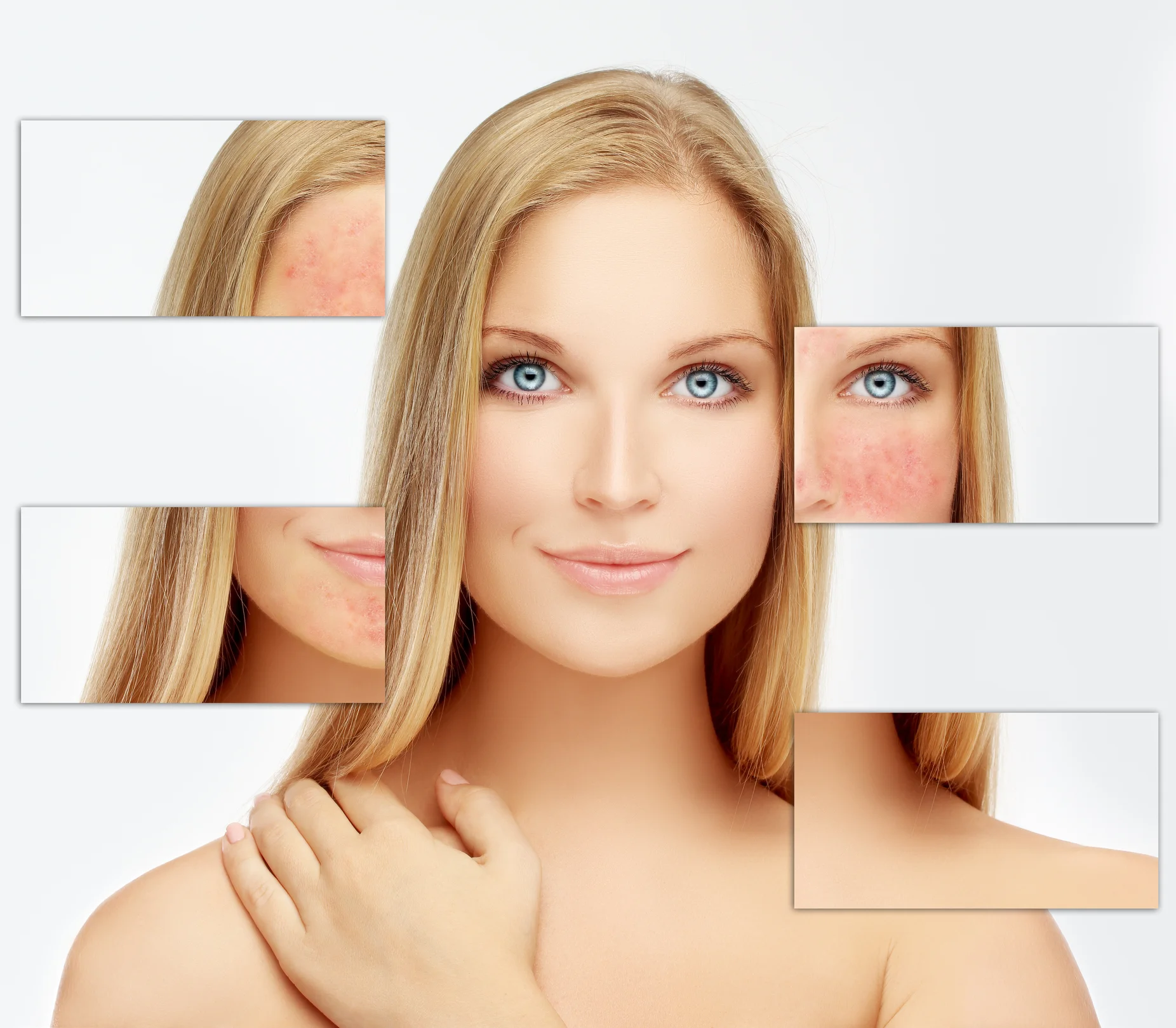 Red Spots Or Rosacea Monarch Aesthetic Medicine Columbus Ohio